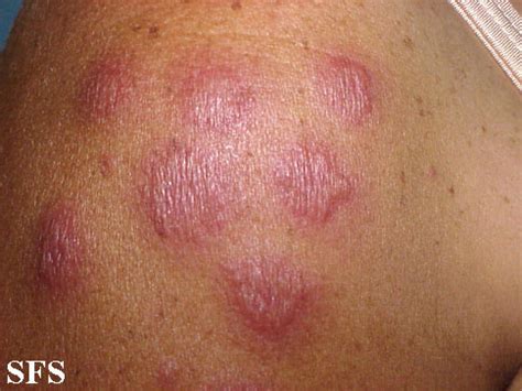 Sweet Syndrome Rash Pictures