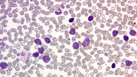 T Cell Acute Lymphoblastic Leukemia Symptoms And Diagnosis