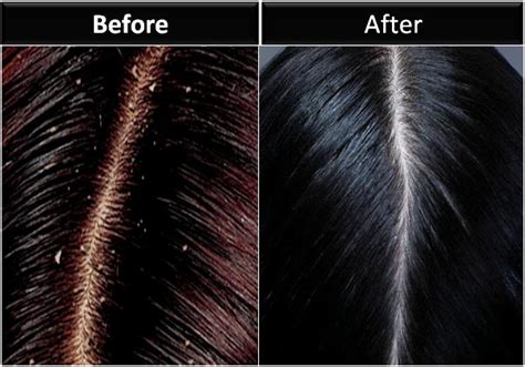Proven Ways To Get Rid Of Dandruff Permanently