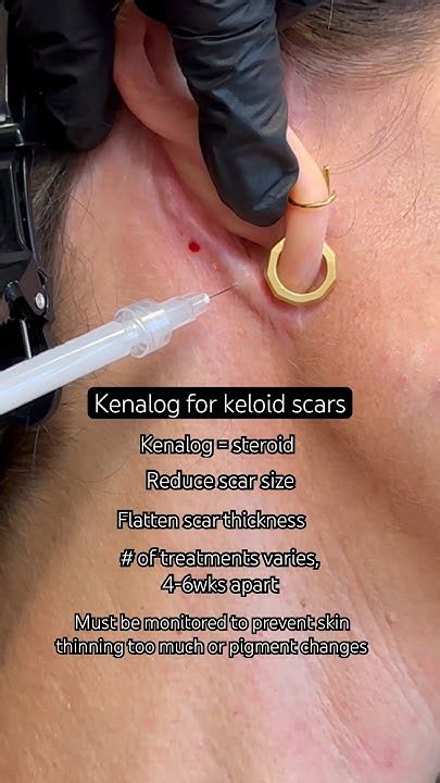 Kenalog For Keloid Scar Treatment Youtube