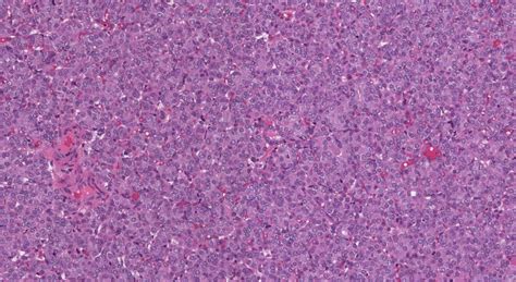 Non Invasive Follicular Thyroid Neoplasm With Papillary Like Nuclear