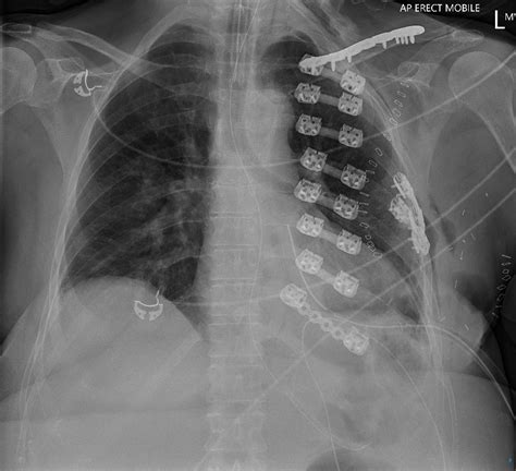 Chest And Rib X Ray Cpt Code At Melvin Murillo Blog