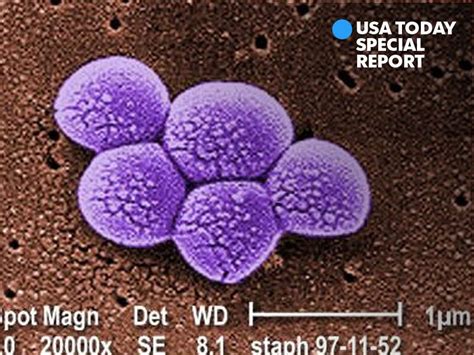 Methicillin Resistant Staphylococcus Aureus Mrsa