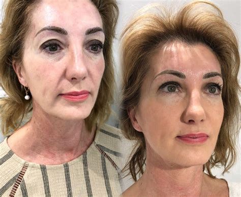 Which Is Better Botox Or Profhilo Or Fillers Aesthetic Clinic Malaysia