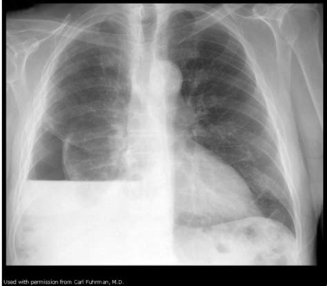 7 Pneumothorax And Hydrothorax Etiology Radiologic Characteristics