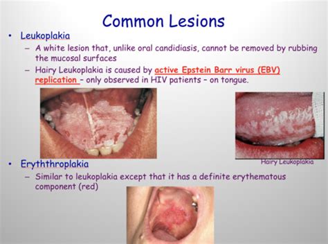 Candidal Leukoplakia