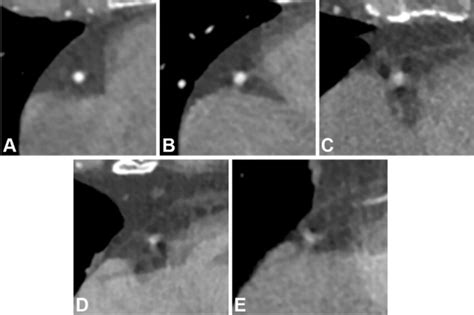A To E Represent The Coronary Segments Scored 5 To 1 In Terms Of The Download Scientific