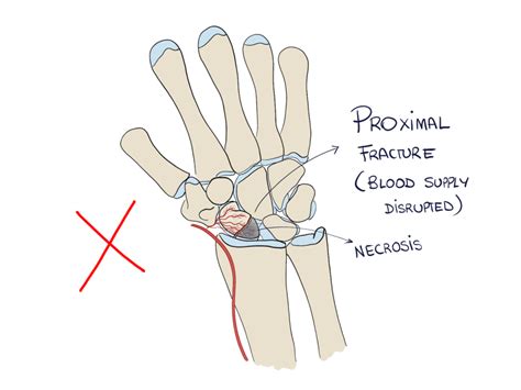 Scaphoid Fracture Zones At Tamara Wilson Blog