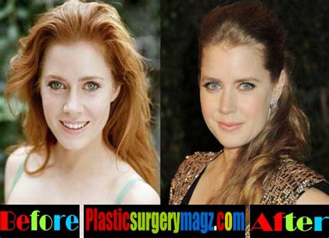 Amy Adams Nasenkorrektur Vorher Und Nachher HÖrzu Ausgabe 432024