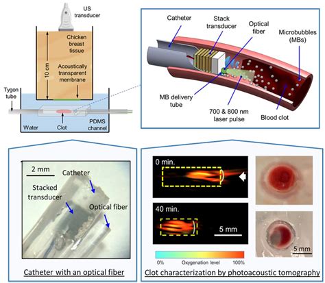 Miniaturized Stacked Transducer For Intravascular Sonothrombolysis With Internal Illumination