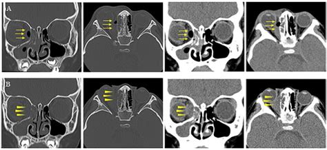 Full Article Surgical Drainage Of Pediatric Gas Containing Orbital