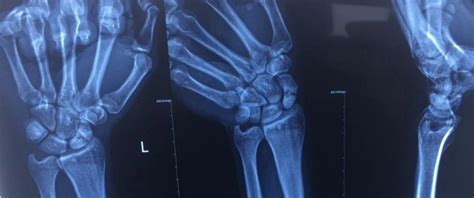 Ahmed Abosalem On Linkedin Non United Fracture Scaphoid Orif Volar Approach Superficial Palmar…
