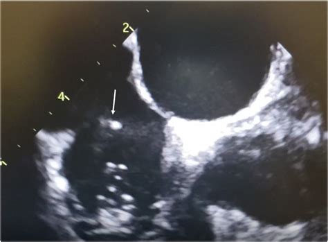 Eustachian Valve Echo A Transesophageal Echocardiography Image