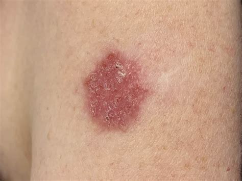 What Causes Superficial Basal Cell Carcinoma