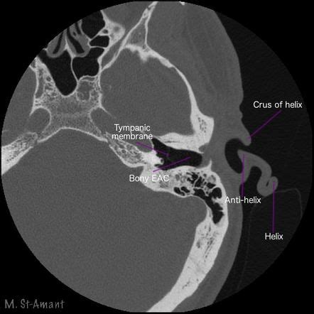 External Auditory Canal Temporal Bone