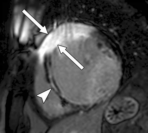 Metal Artifact Reduction In Cardiovascular Mri For Accurate Myocardial