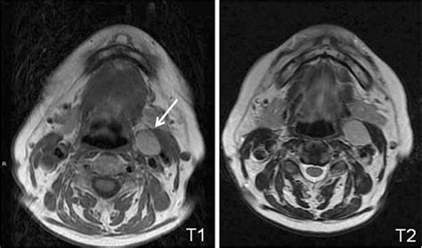 Example Of A Metastatic T1 Hyperintense Left Level Ii Lymph Node Download Scientific Diagram