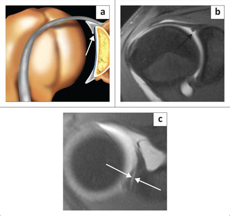 Superior Labrum Anterior To Posterior Lesions Part 1 Imaging And