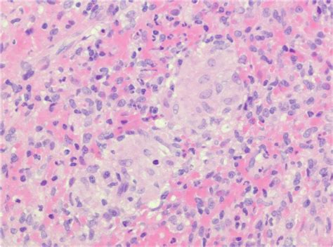 Histopathological Features Of Patients With Chronic Granulomatous Disease