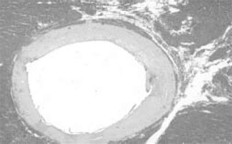 Histological Cross Section Of A Fibrin Sheath And Surrounding