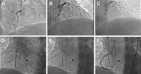 A B Cardiac Catheterization Showed De Novo Cto Rca Distal To The