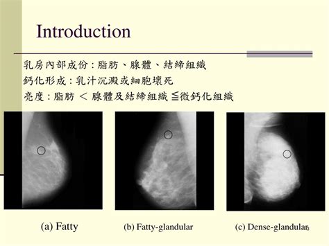 Ppt Detection Microcalcifications In Mammograms Using Wavelet