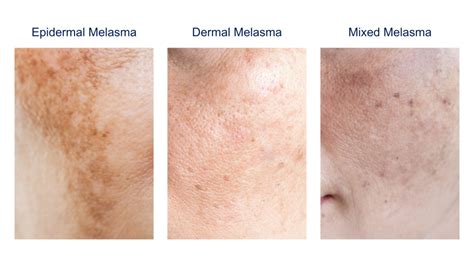 Melasma Treatment In Singapore Dream Plastic Surgery