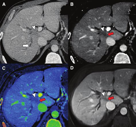 Lesion Detection Using De Ct Material Specific Images In A 45 Yearold