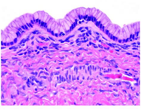 Benign Mucinous Tumors Of The Ovary Consist Of Simple Nonstratified