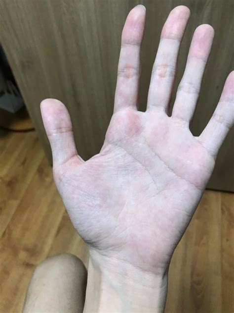 손 발진 매독 문의 지식in