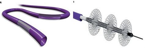 The Flowtriever Catheter A The 20f Flexible Flowtriever Catheter B