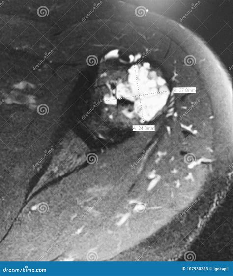 Wielki Chondroid Lesion Mri Egzamin Obraz Stock Obraz Złożonej Z Szpik Ciało 107930323 Wielki Chondroid Lesion Mri Egzamin Obraz Stock Obraz Złożonej Z Szpik Ciało 107930323
