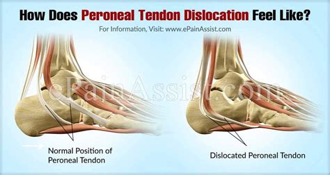 How Does Peroneal Tendon Dislocation Feel Like