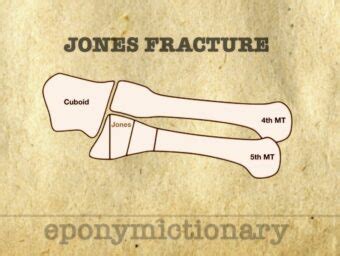 Jones Fracture Archives • Litfl