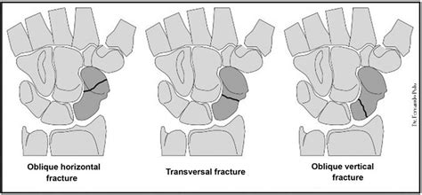 Russe Classification For Scaphoid Fractures 1960 1 Oblique Download Scientific Diagram
