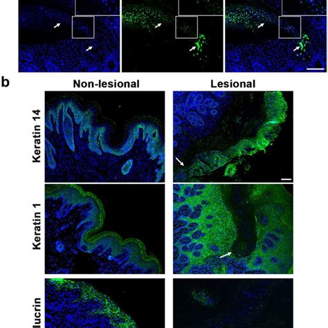 Abnormal Apoptosis And Differentiation Of Keratinocytes In The Lesional Download High