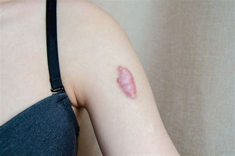 Como Evitar Queloide Aprenda Cuidados Essenciais Para Prevenir