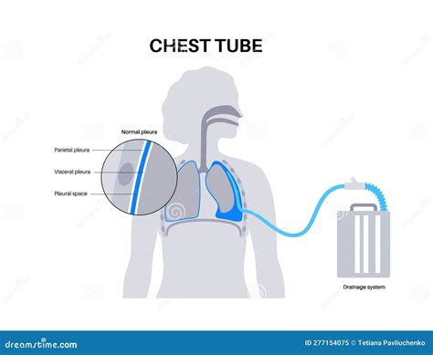 Chest Tube Catheter Cartoon Vector 277154075