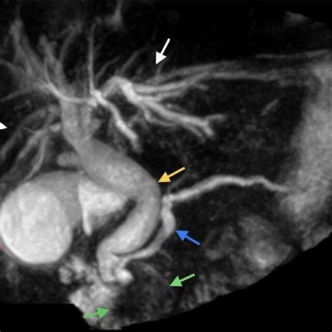 Magnetic Resonance Cholangiopancreatography Mrcp Demonstrates