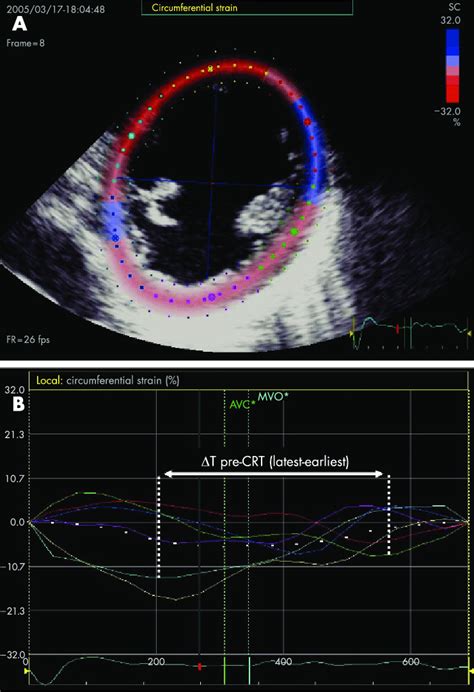 A Short Axis View With Circumferential Strain Display Before