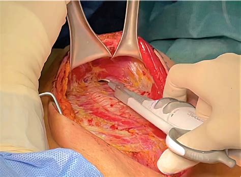 Figure 2 From Subpectoral Dissection Using An Ultrasonic Energy Device