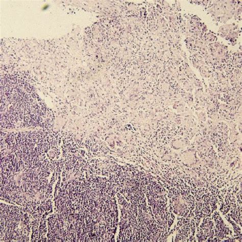 Cases Of Human Protothecal Infection Caused By Prototheca Zopfii