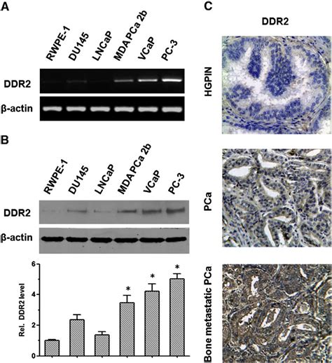 Ddr2 Is Highly Expressed In Bone Metastatic Pca Cells And Tissues A