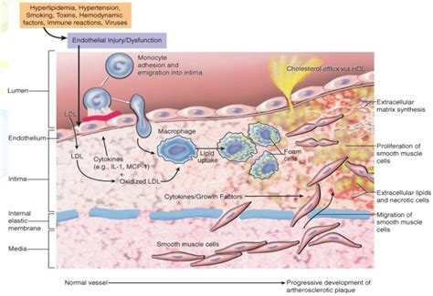 循环病理学：动脉粥样硬化系列疾病 知乎