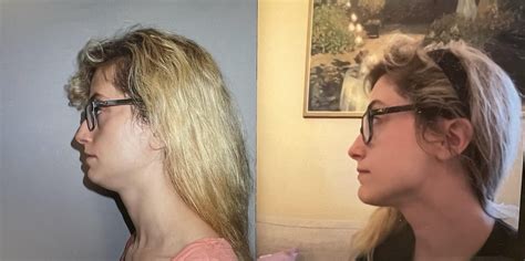 Mouth Breather Profile