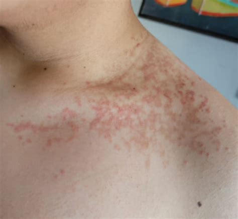 A 16 Year Old Hispanic Male With A History Of Hyperlipidemia Reports A Pruritic Rash On His Neck