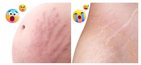How To Deal With Red And White Pregnancy Stretch Marks