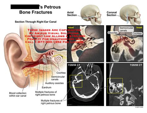 Petrous Bone Petrous Pyramid