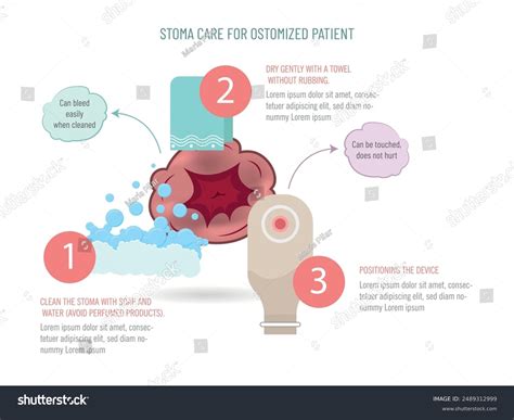 Visual Guide Stoma Care Ostomized Patients Stock Vector Royalty Free 2489312999 Shutterstock