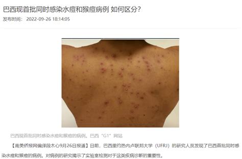 巴西疫情 巴西现首批同时感染水痘和猴痘病例，非洲以外新情况 迈跃生物